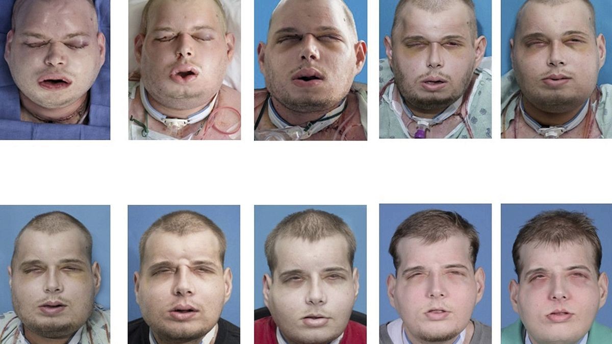 Das neue Gesicht des Feuerwehrmanns Patrick Hardison