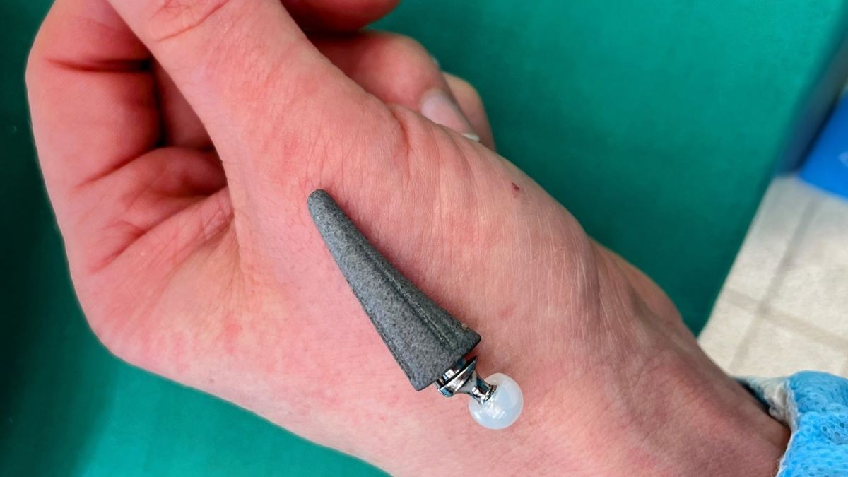 Erste Klinikum-Patientin mit künstlichem Minigelenk im Daumen