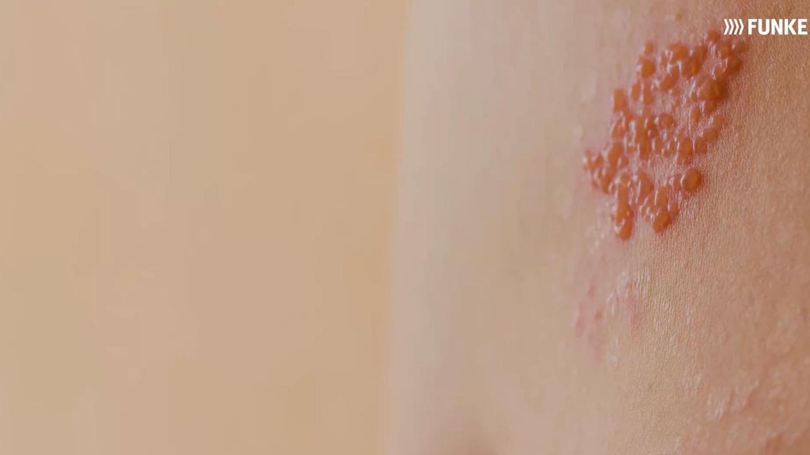 Gürtelrose: Ursache, Symptome und Behandlung