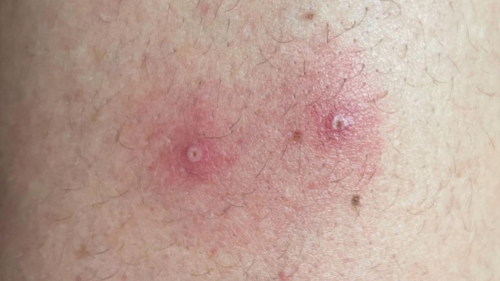 Mpox: Bilder der Pusteln – So sieht der Ausschlag aus