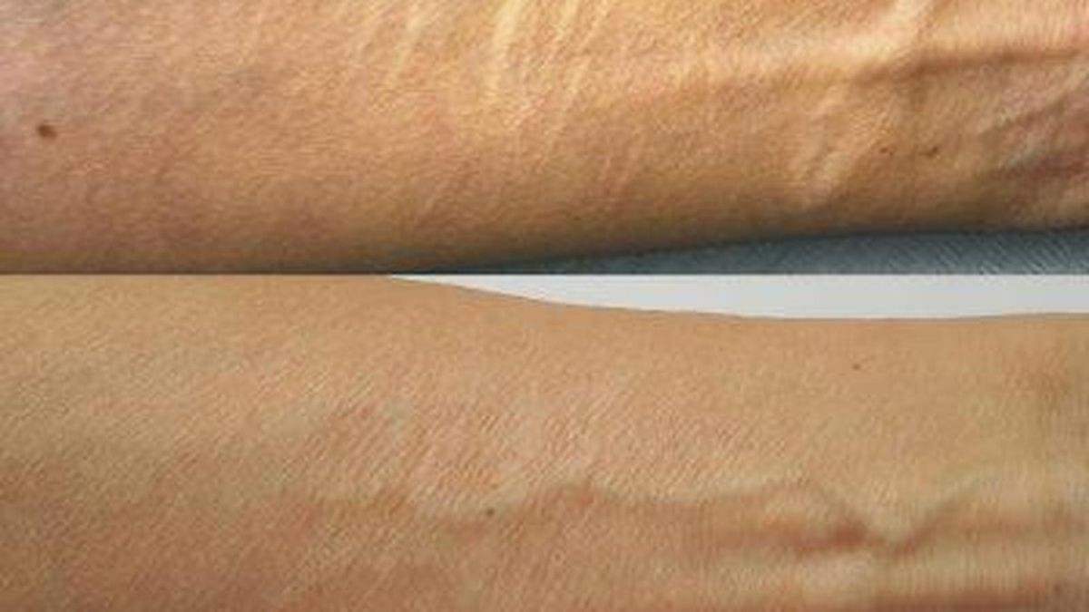 Medizinische Tattoos in Berlin: Diese Frau macht Narben unsichtbar